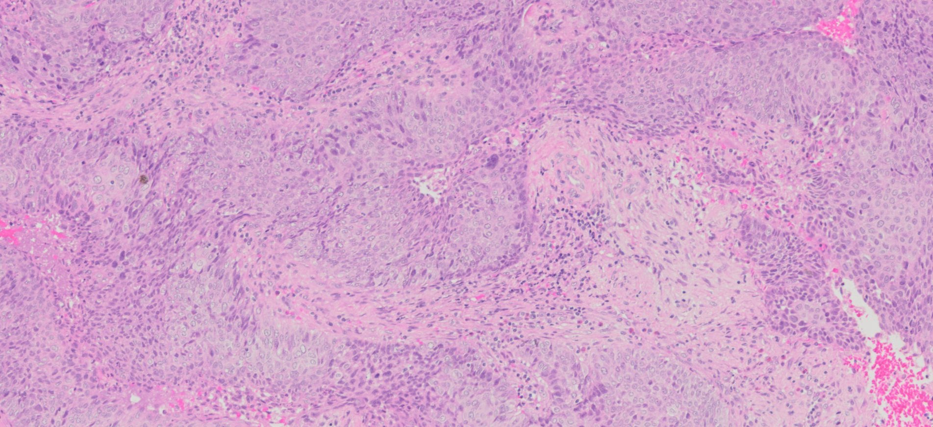 Human Lung Squamous Cell Carcinoma Ffpe Sections