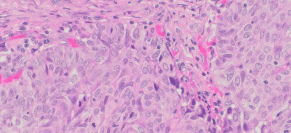 Human Lung Squamous Cell Carcinoma FFPE Sections