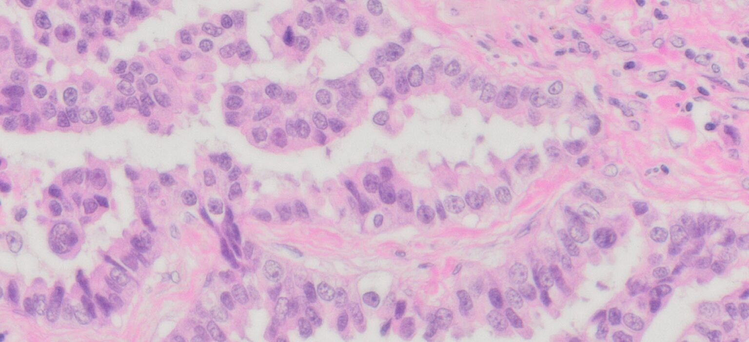 Human Lung Adenocarcinoma FFPE Sections