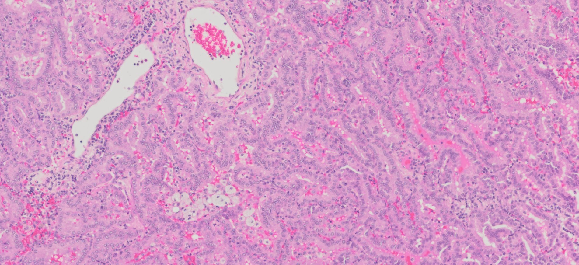 Human Lung Adenocarcinoma FFPE Sections