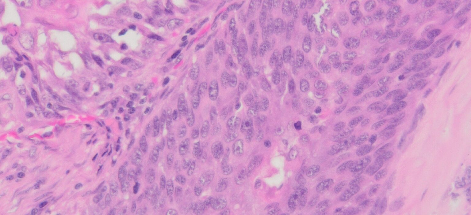 Human Lung Squamous Cell Carcinoma FFPE Sections