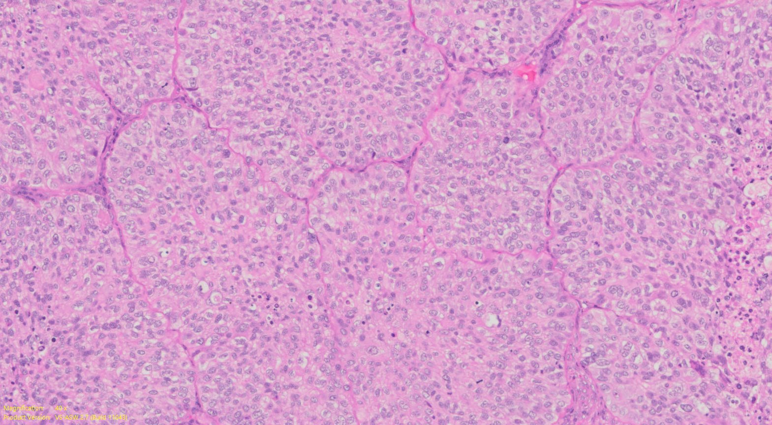 Human Lung Adenocarcinoma FFPE Sections
