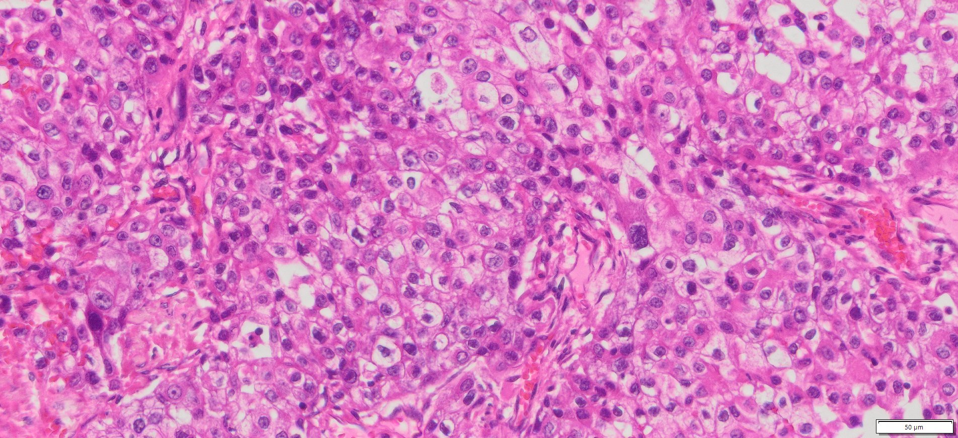 Human Breast Cancer, Triple Negative (ER-/PR-/Her2-), (Infiltrating ...