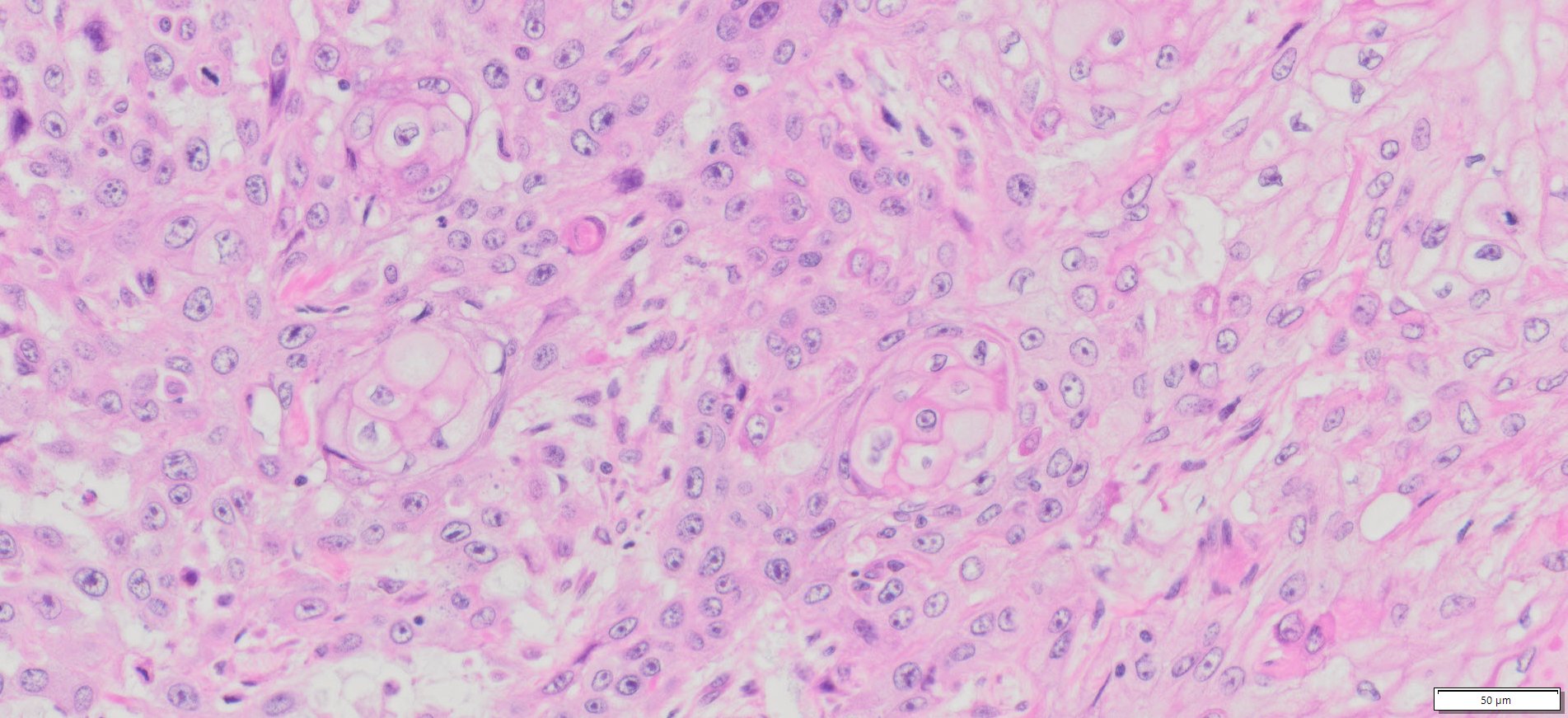 Human Breast Cancer, Triple Negative (ER-/PR-/Her2-), (Infiltrating ...