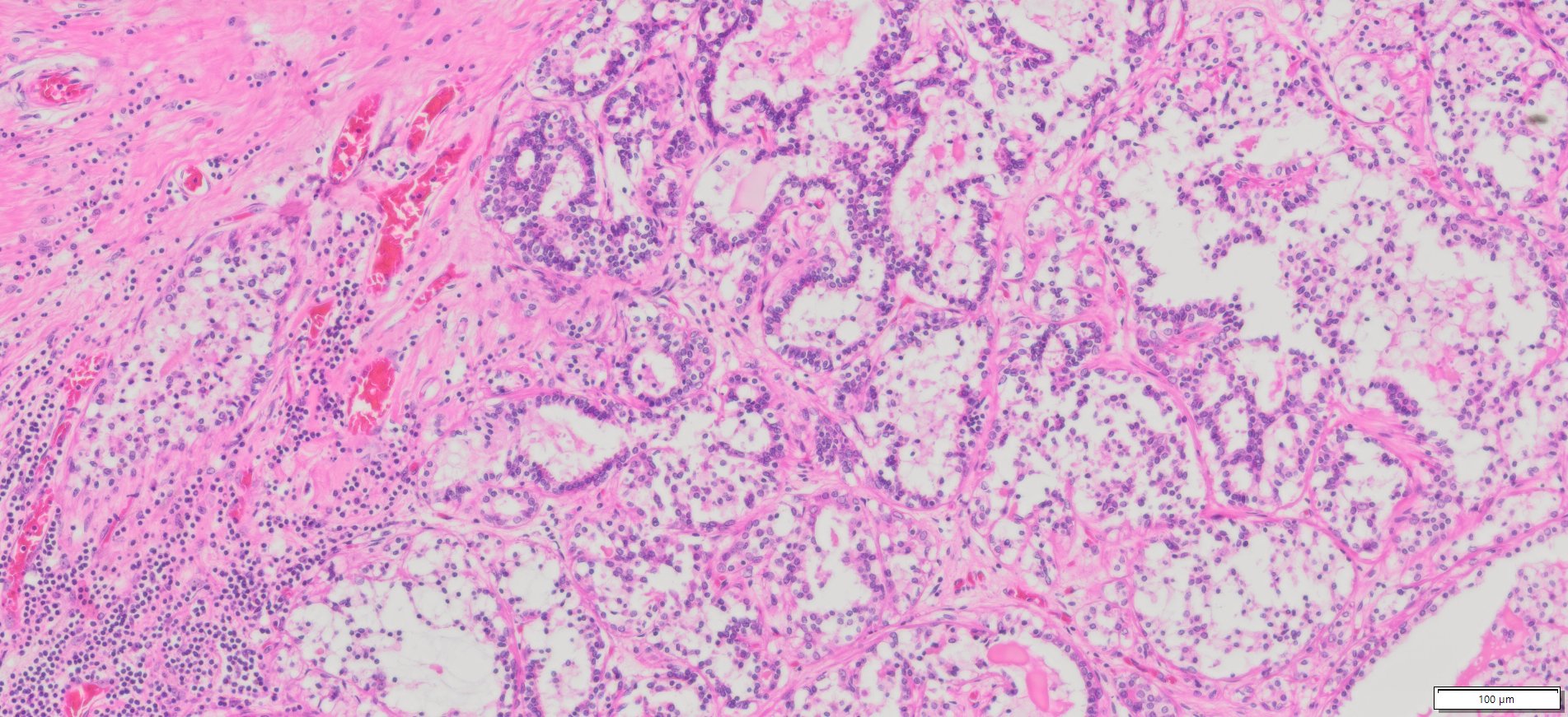 Human Breast Cancer, Triple Negative (ER-/PR-/Her2-), (Infiltrating ...