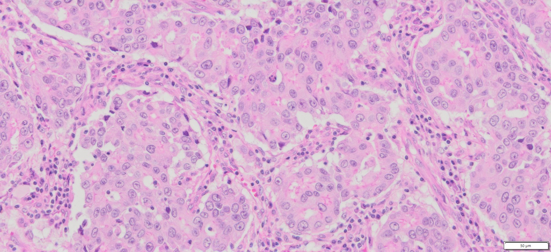 Human Breast Cancer, Triple Negative (ER-/PR-/Her2-), (Invasive duct ...