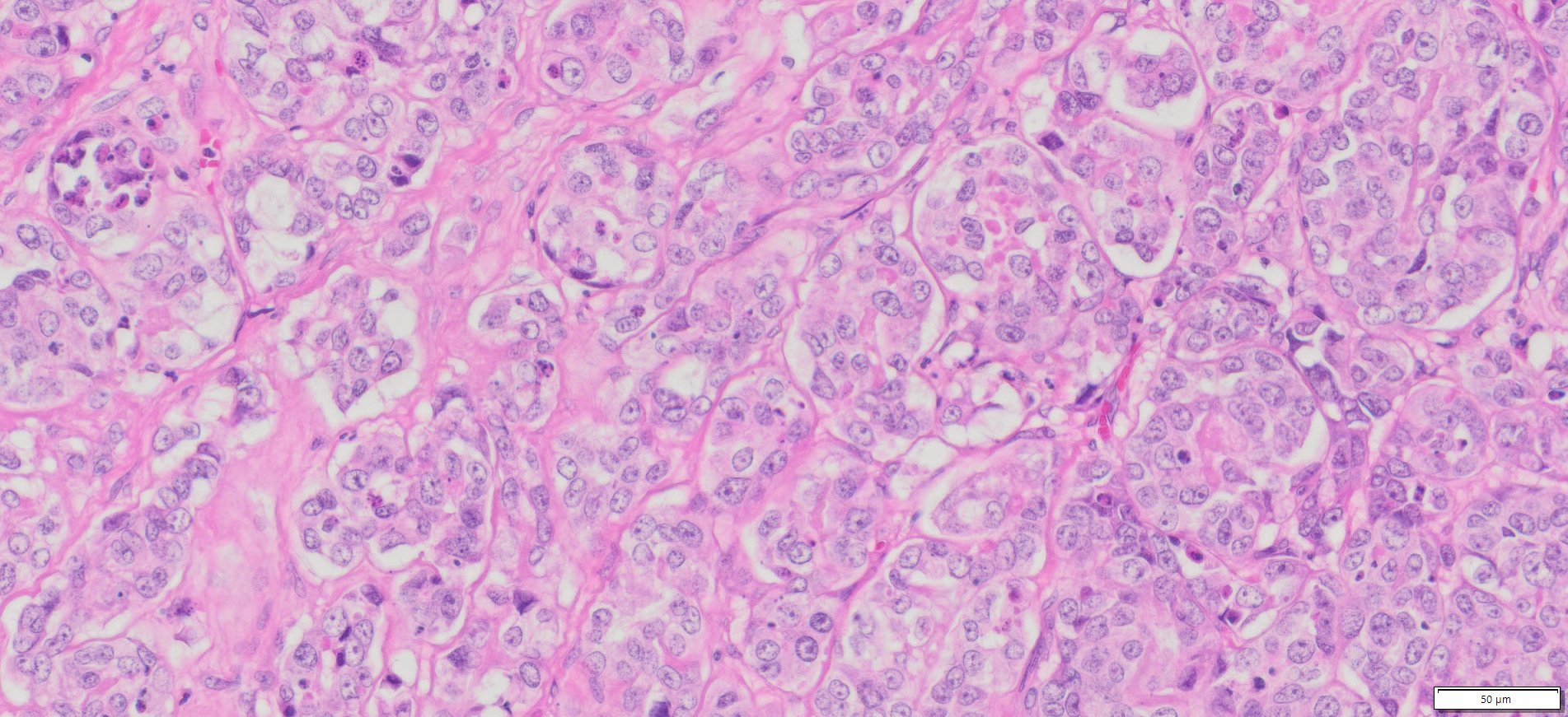 Human Breast Cancer, Triple Negative (ER-/PR-/Her2-), (Infiltrating ...