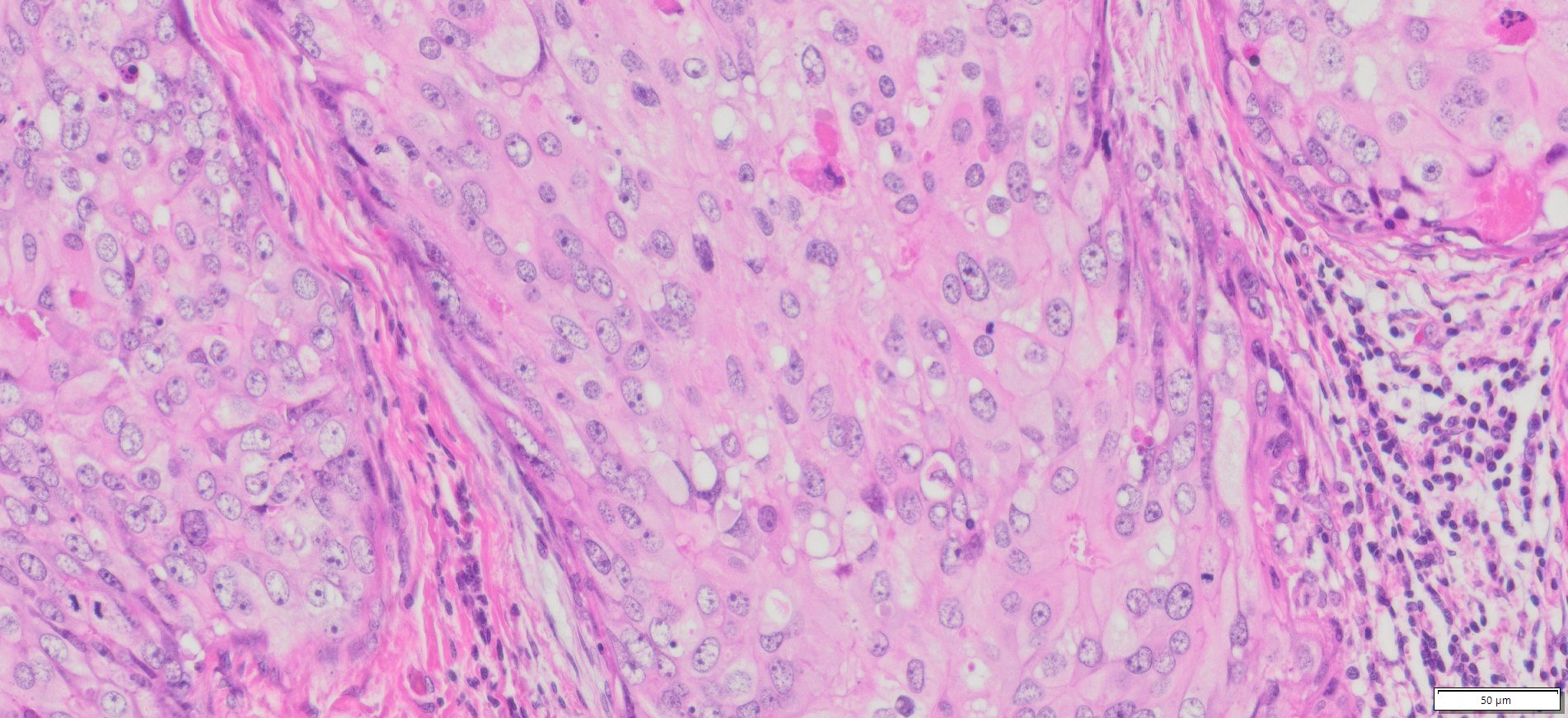 Human Breast Cancer, Triple Negative (ER-/PR-/Her2-), (Infiltrating ...