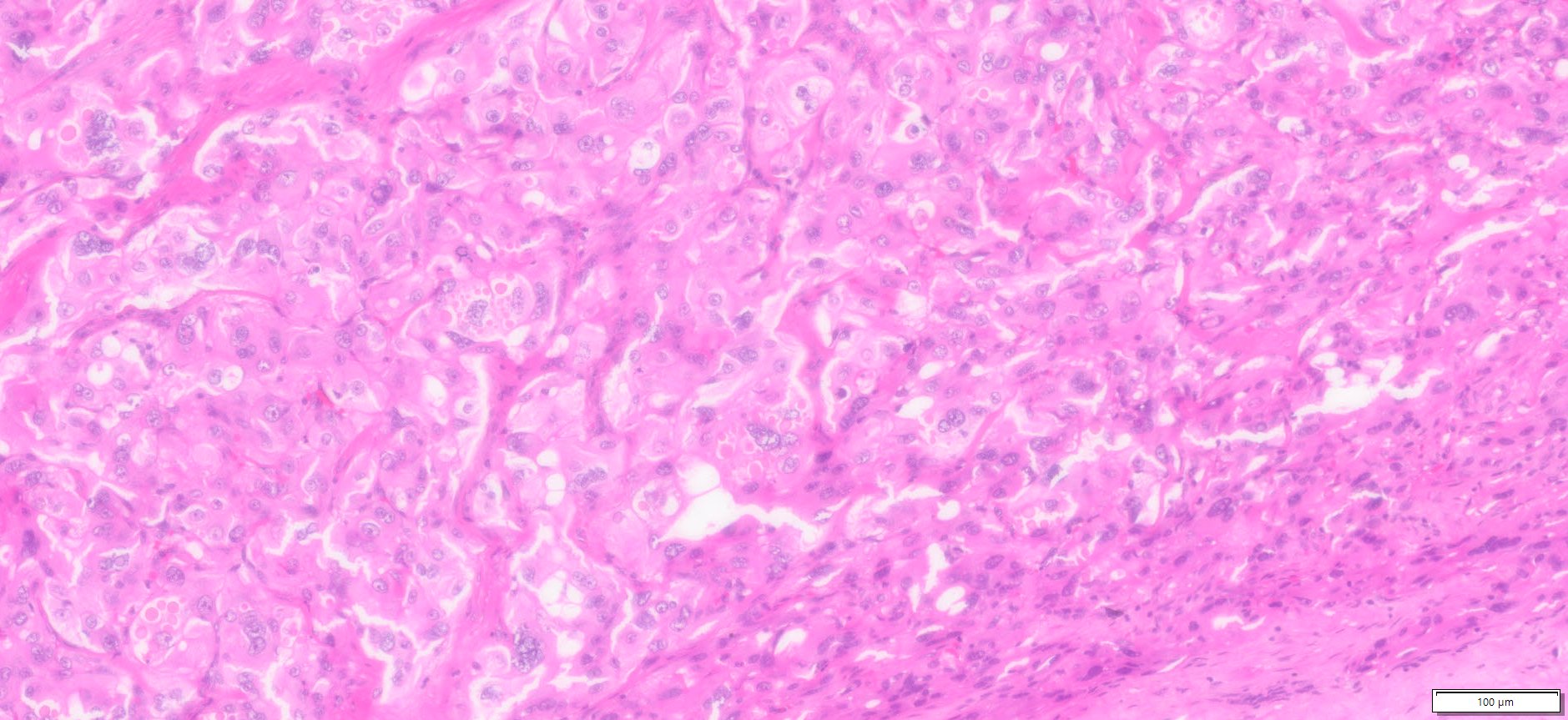 Human Liver Cancer (Hepatocellular carcinoma) FFPE Sections
