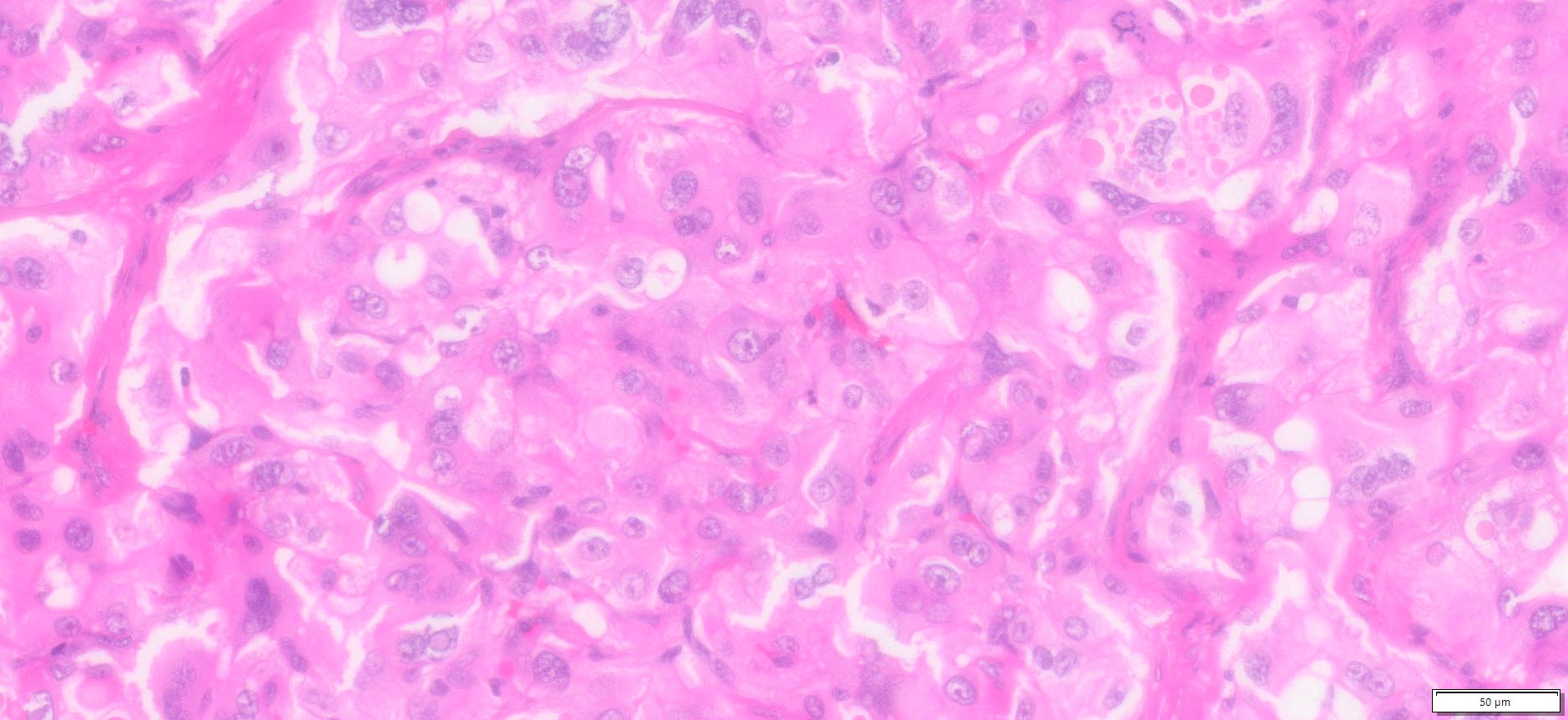Human Liver Cancer (Hepatocellular carcinoma) FFPE Sections