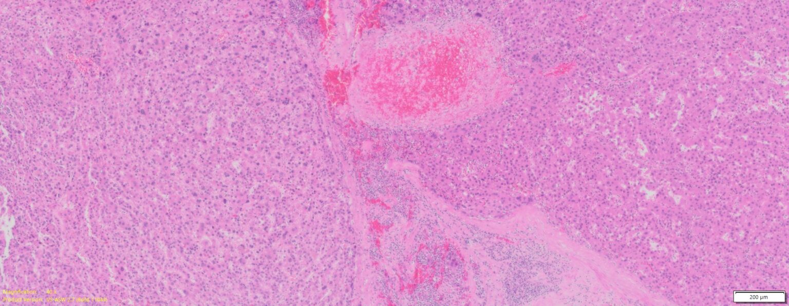 Human Liver Cancer (Hepatocellular carcinoma) FFPE Sections