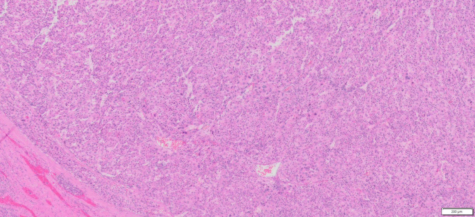Human Liver Cancer (Hepatocellular carcinoma) FFPE Sections
