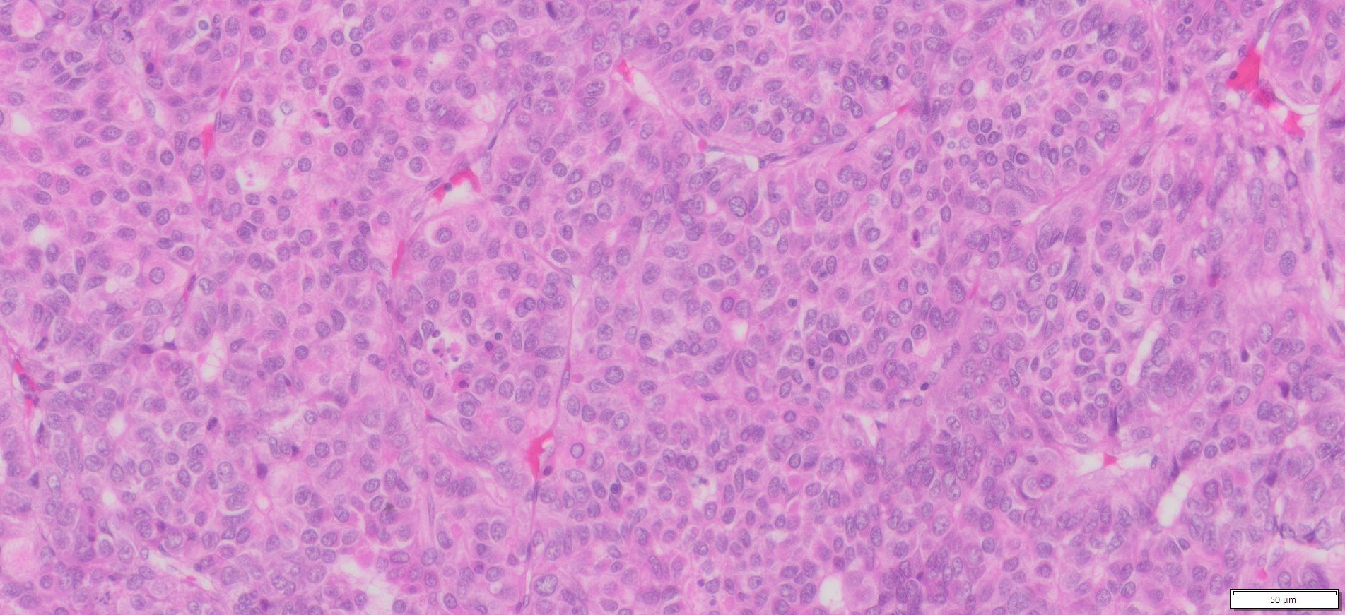 Human Liver Cancer (Hepatocellular carcinoma) FFPE Sections