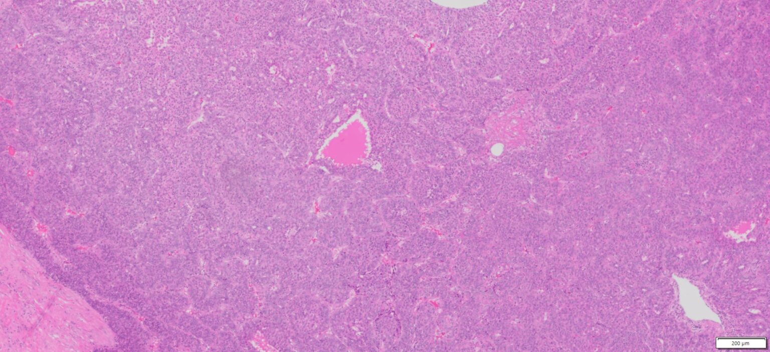 Human Liver Cancer (Hepatocellular carcinoma) FFPE Sections