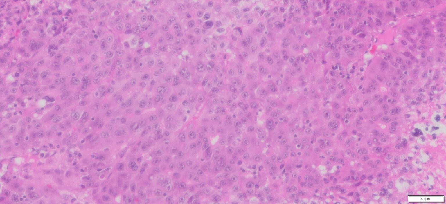 Human Liver Cancer (Hepatocellular carcinoma) FFPE Sections