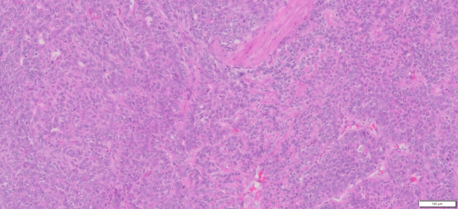 Human Liver Cancer (Hepatocellular carcinoma) FFPE Sections