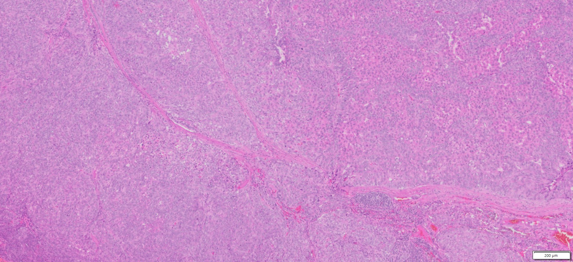 Human Liver Cancer (Hepatocellular carcinoma) FFPE Sections