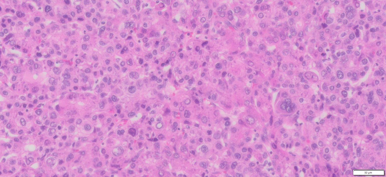 Human Liver Cancer (Hepatocellular carcinoma) FFPE Sections