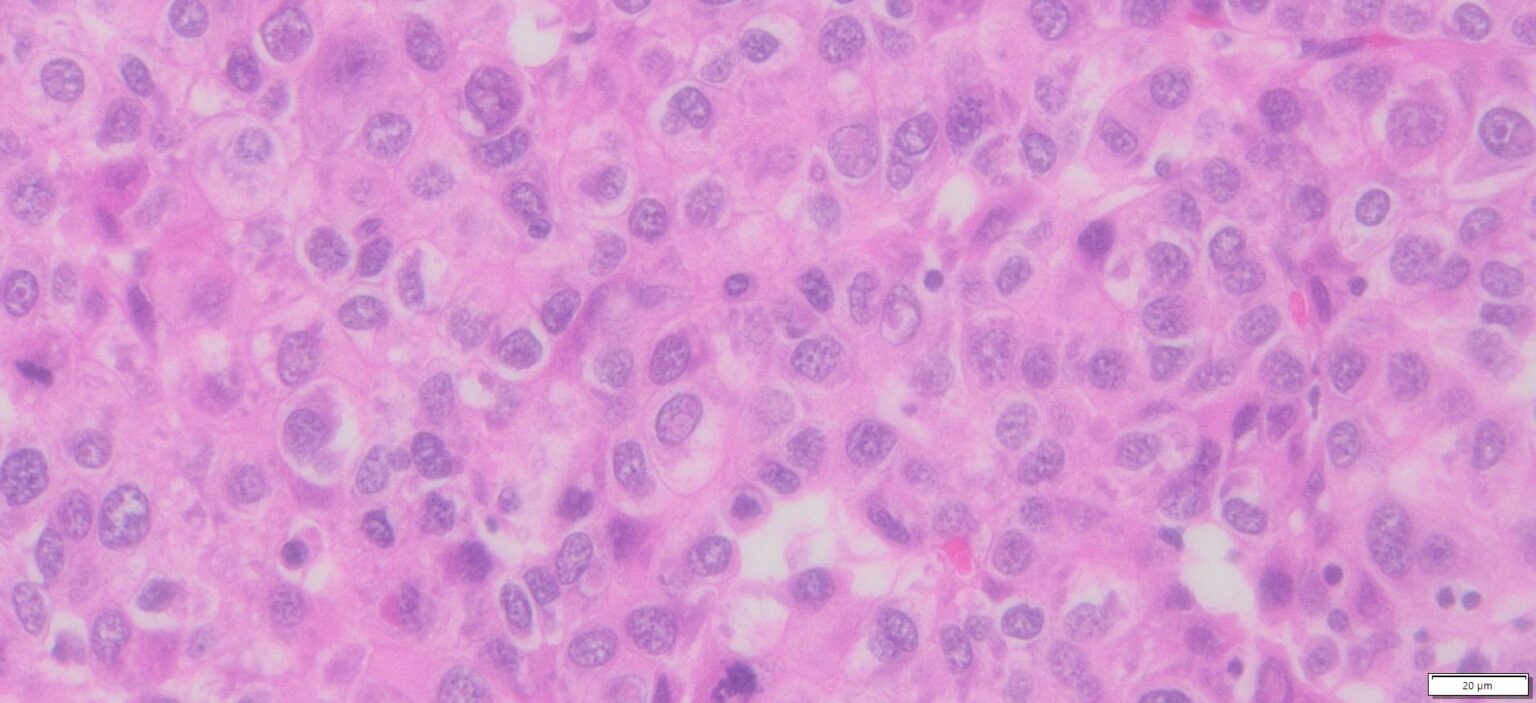 Human Liver Cancer (Hepatocellular carcinoma) FFPE Sections