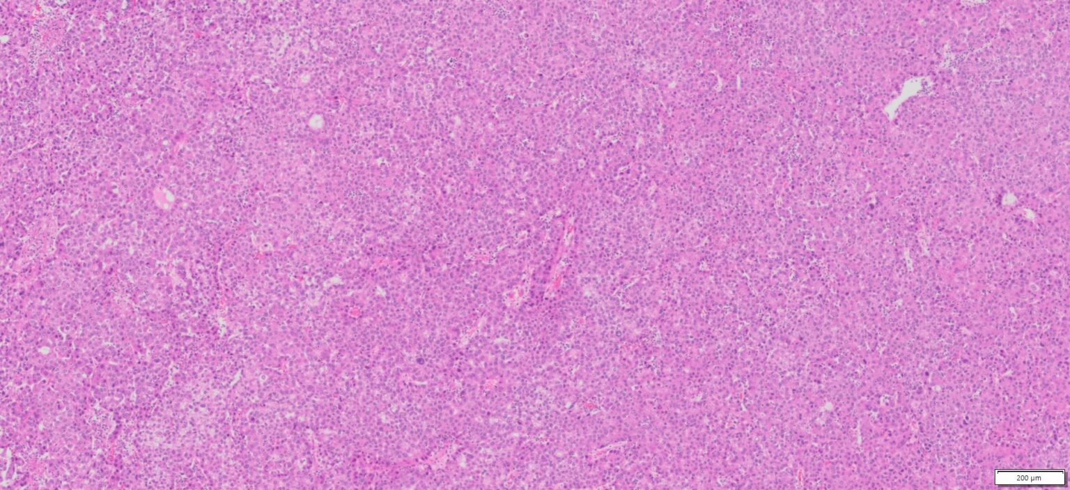 Human Liver Cancer (Hepatocellular carcinoma) FFPE Sections
