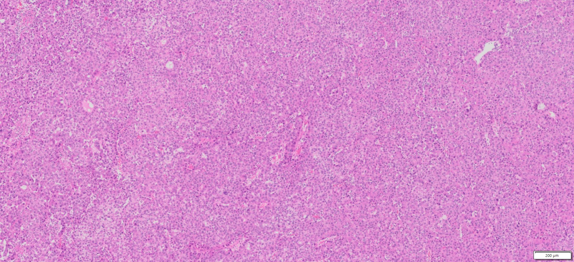 Human Liver Cancer (Hepatocellular carcinoma) FFPE Sections