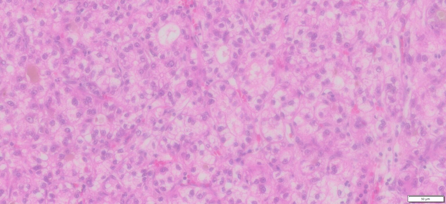 Human Liver Cancer (Hepatocellular carcinoma) FFPE Sections