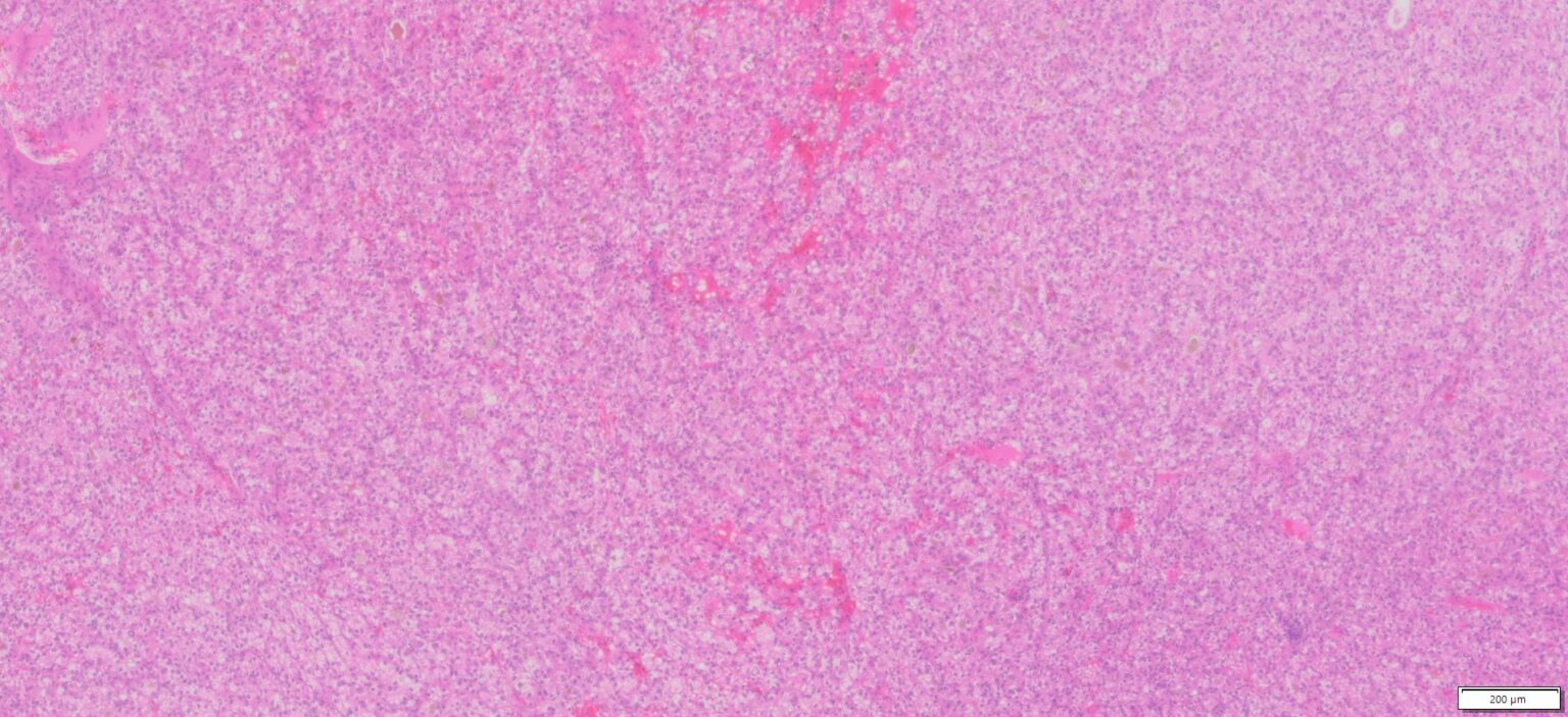 Human Liver Cancer (Hepatocellular carcinoma) FFPE Sections