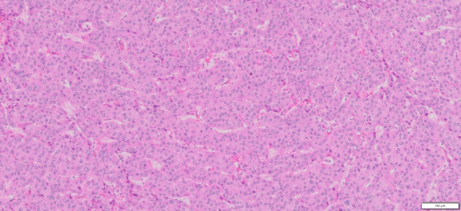 Human Liver Cancer (Hepatocellular carcinoma) FFPE Sections