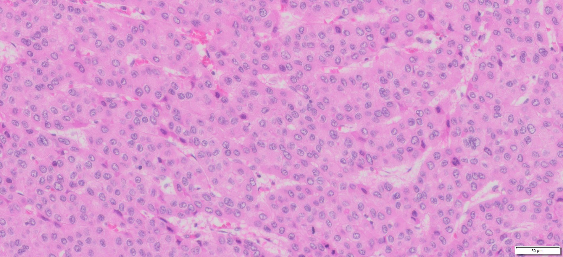 Human Liver Cancer (Hepatocellular carcinoma) FFPE Sections