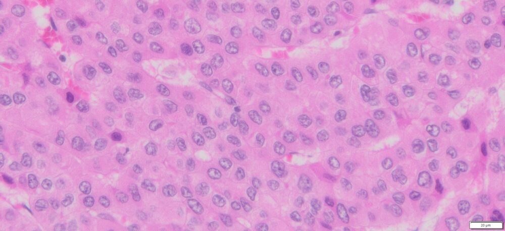 Human Liver Cancer (Hepatocellular carcinoma) FFPE Sections