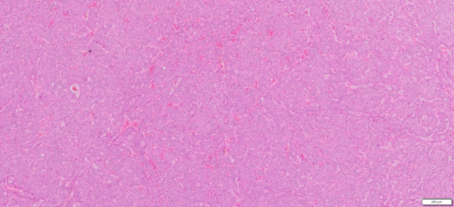 Human Liver Cancer (Hepatocellular carcinoma) FFPE Sections