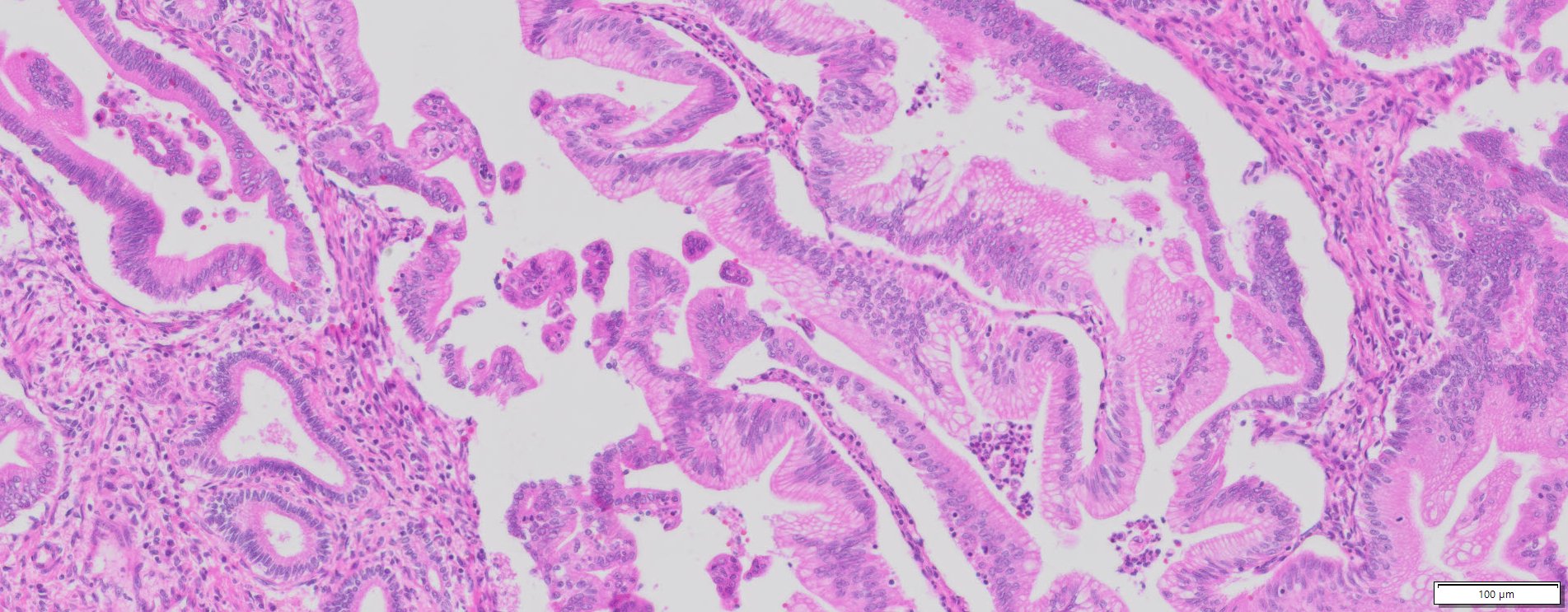 Human Pancreas Cancer (Adenocarcinoma) FFPE Sections