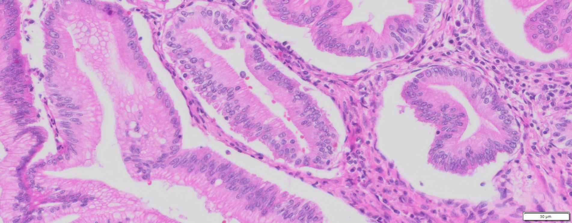 Human Pancreas Cancer (Adenocarcinoma) FFPE Sections