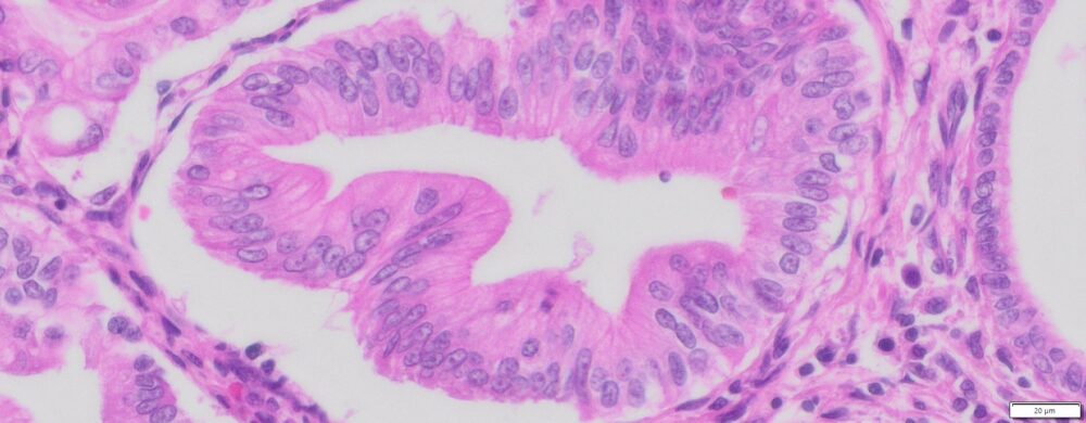 Human Pancreas Cancer (Adenocarcinoma) FFPE Sections