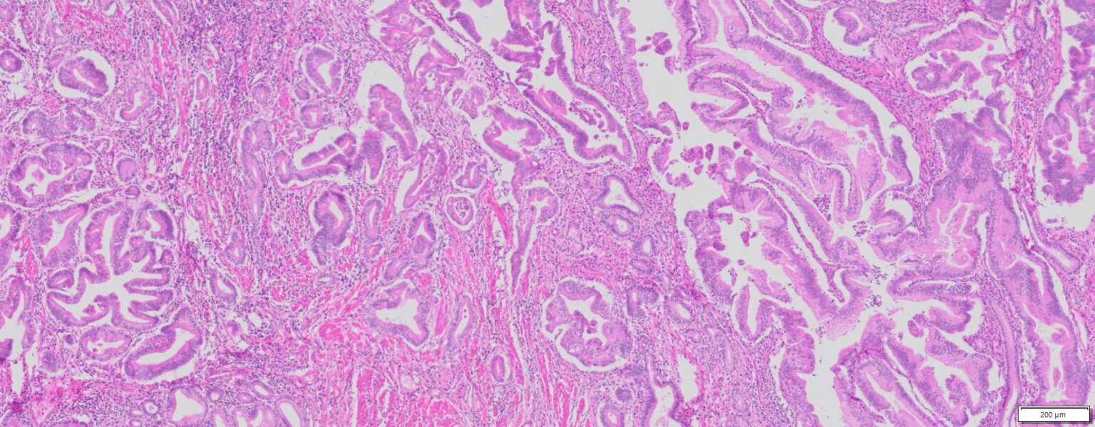 Human Pancreas Cancer (Adenocarcinoma) FFPE Sections