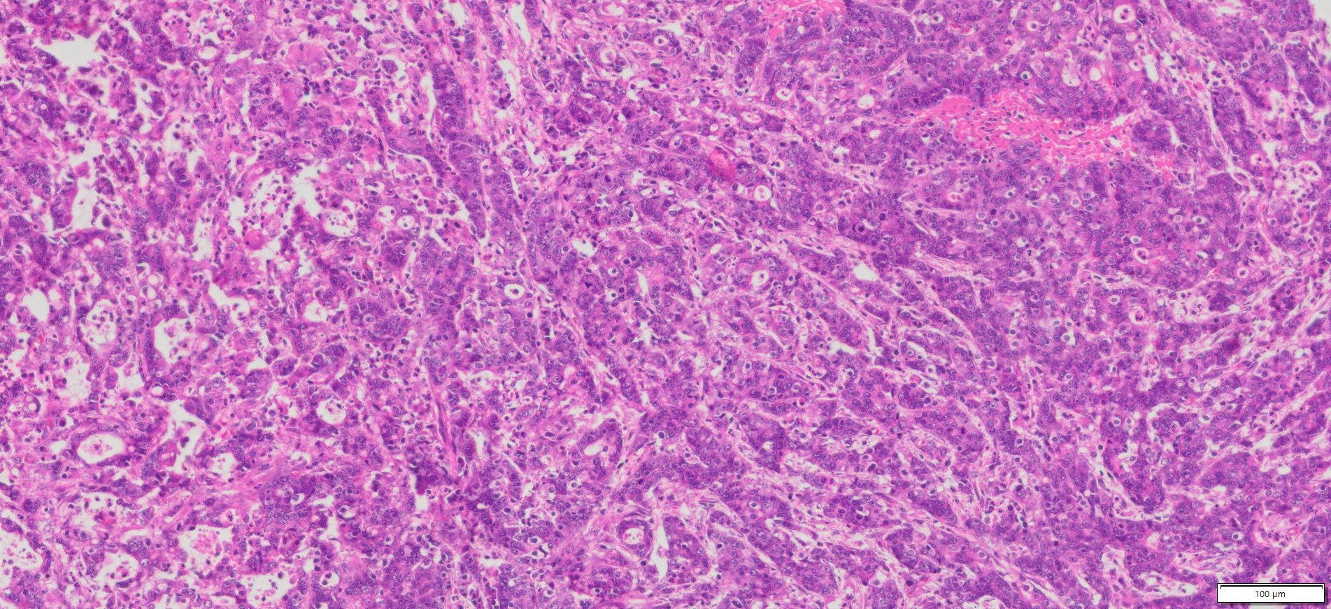 Human Gastric (Stomach adenocarcinoma) FFPE Sections