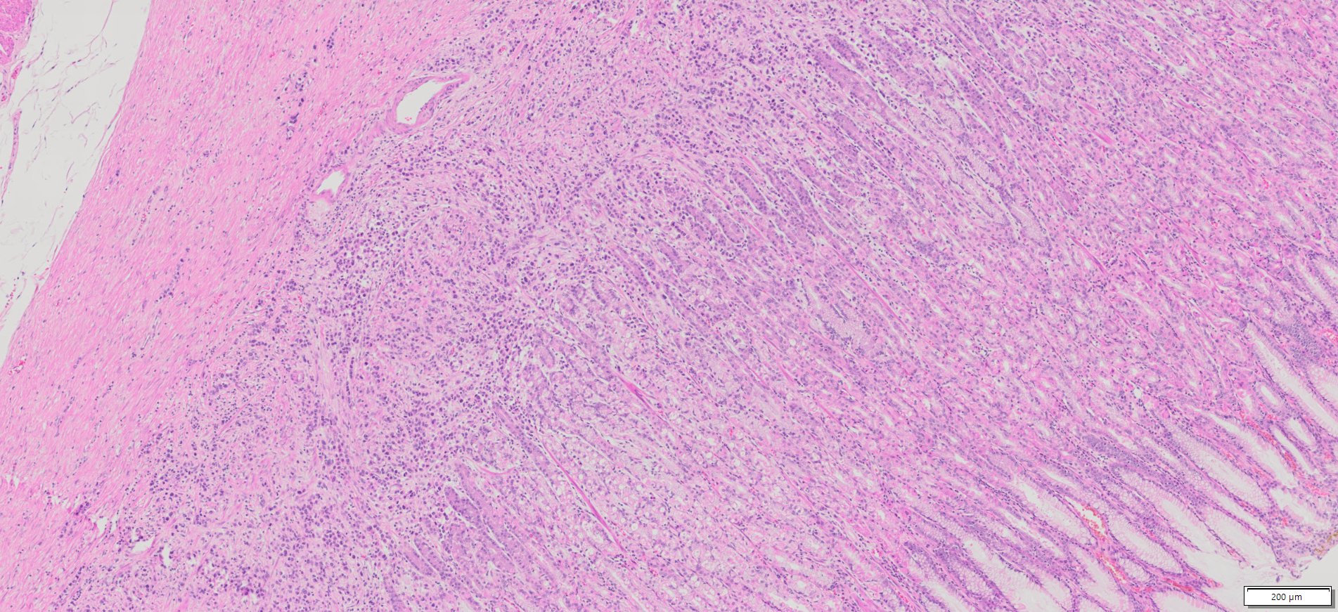 Human Gastric (Gastric pylorus adenocarcinoma) FFPE Sections