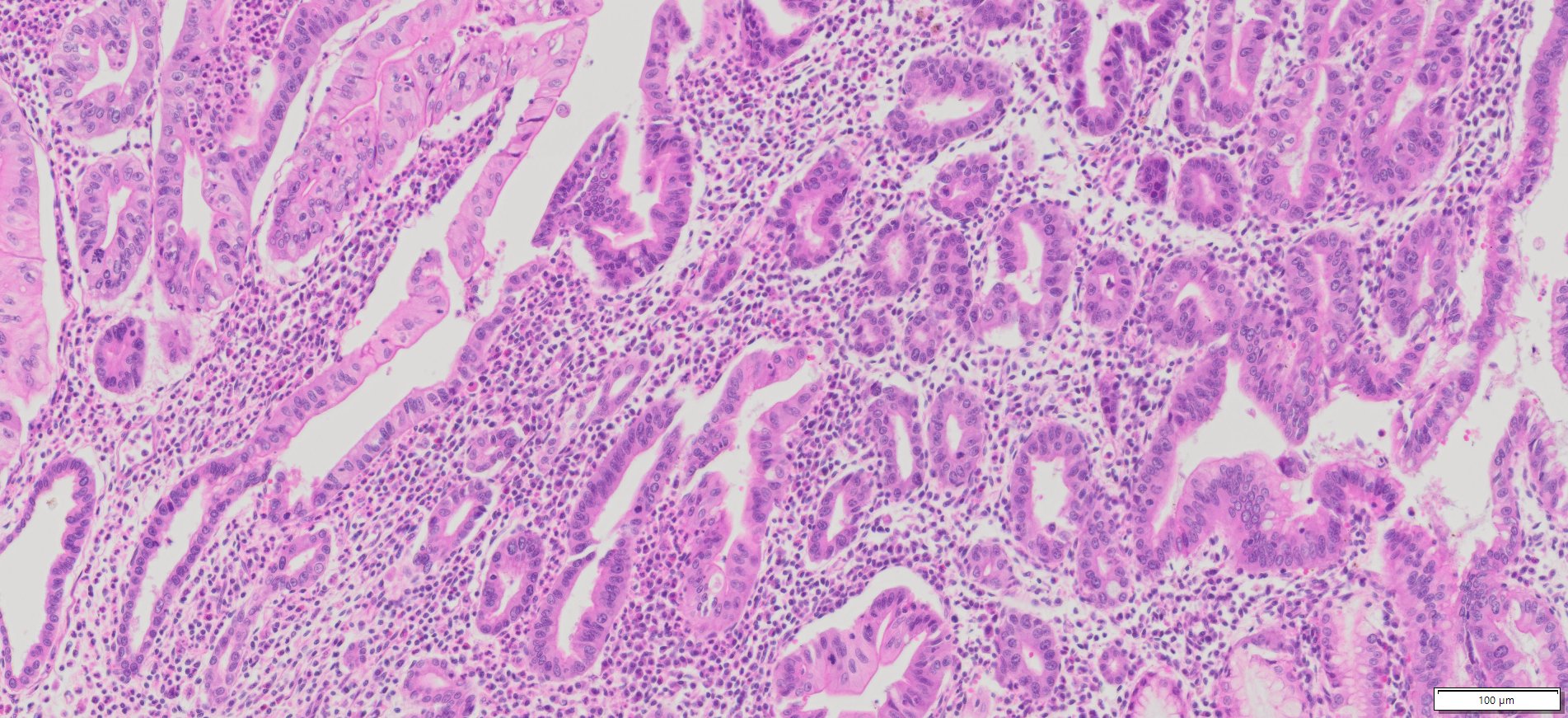 Human Gastric (Stomach adenocarcinoma) FFPE Sections