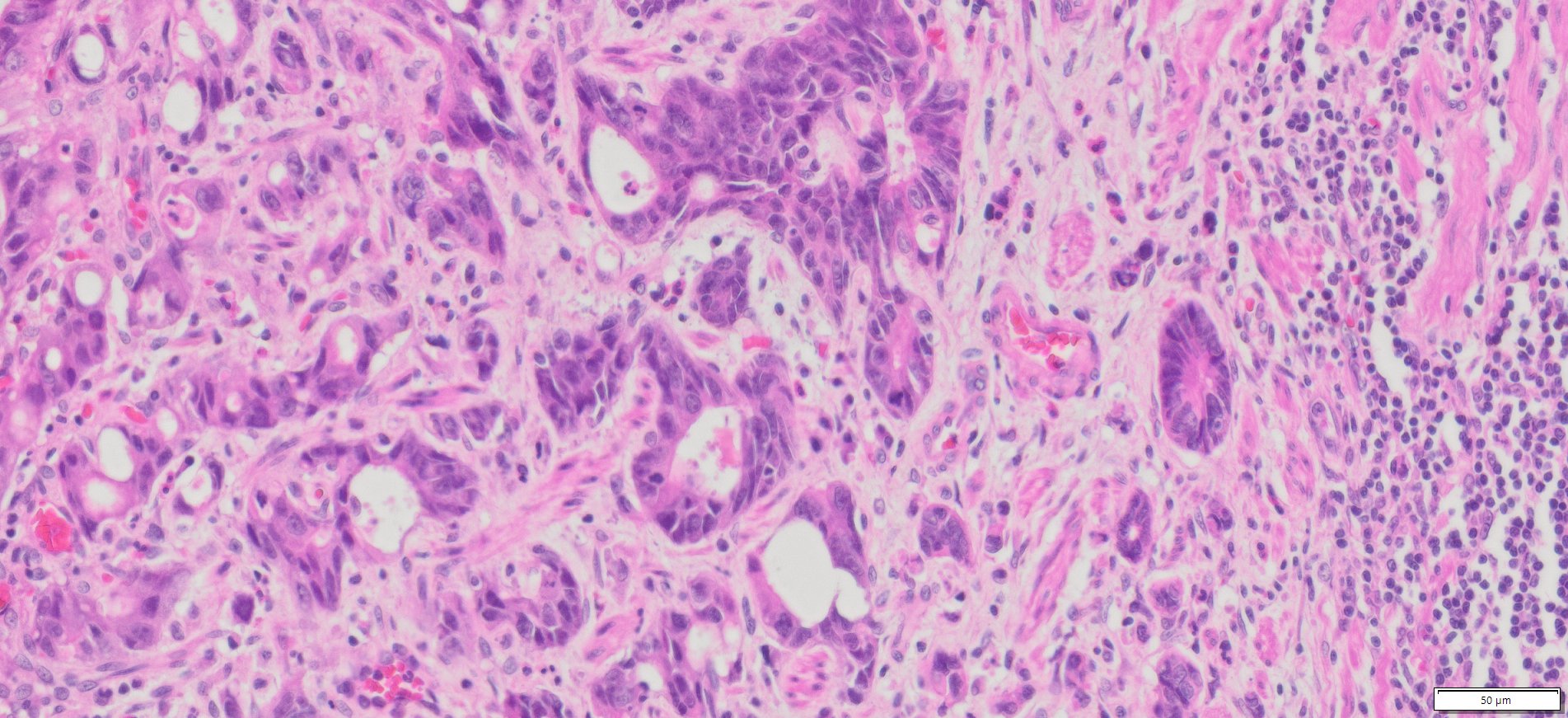 Human Gastric (Stomach adenocarcinoma) FFPE Sections