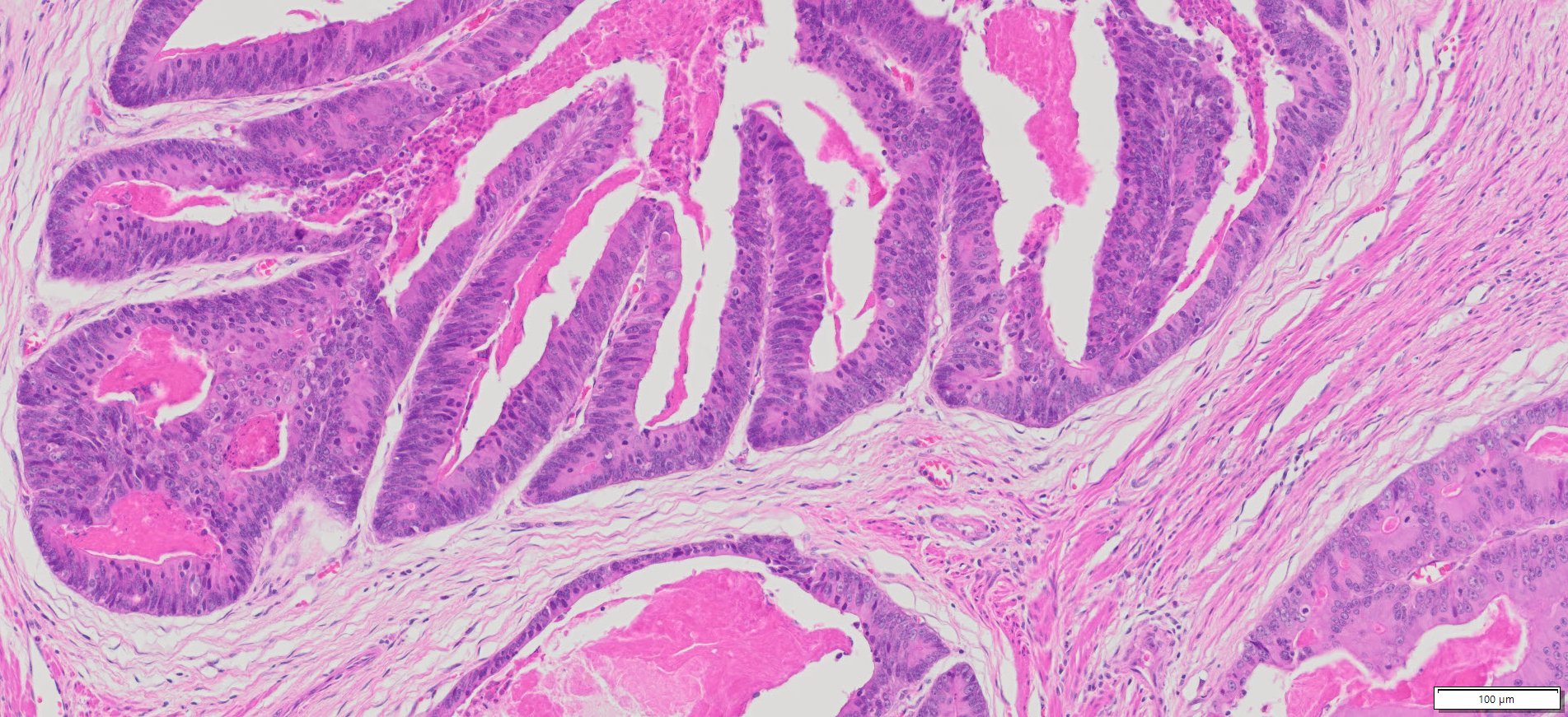 Human Gastric (Stomach adenocarcinoma) FFPE Sections