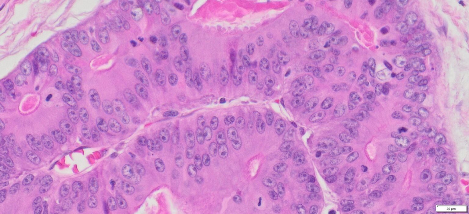 Human Gastric (Stomach adenocarcinoma) FFPE Sections