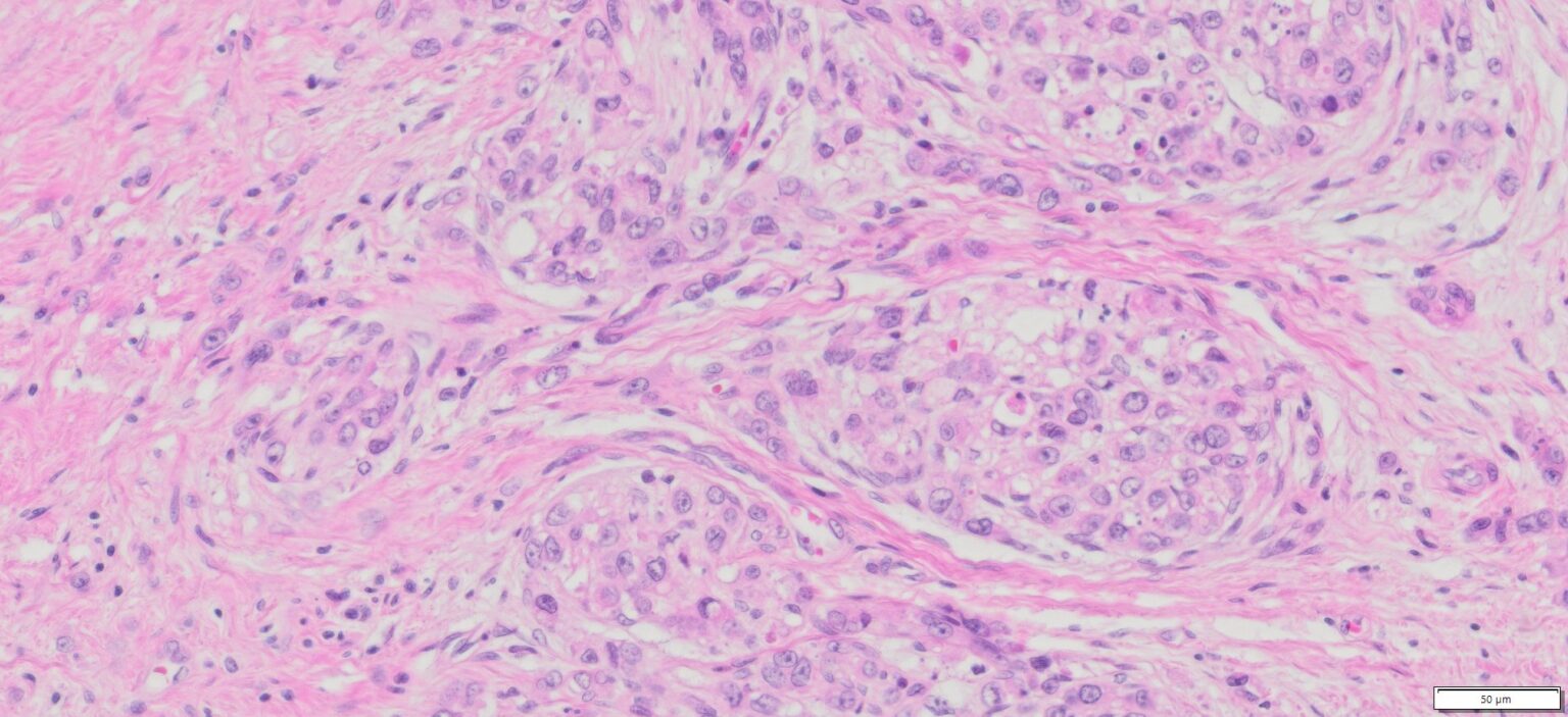Human Gastric (Stomach adenocarcinoma) FFPE Sections