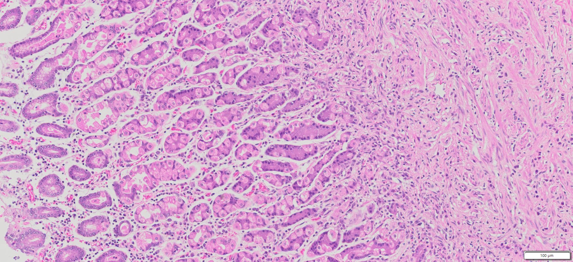 Human Gastric (Stomach adenocarcinoma of non-signet ring cell) FFPE Sections
