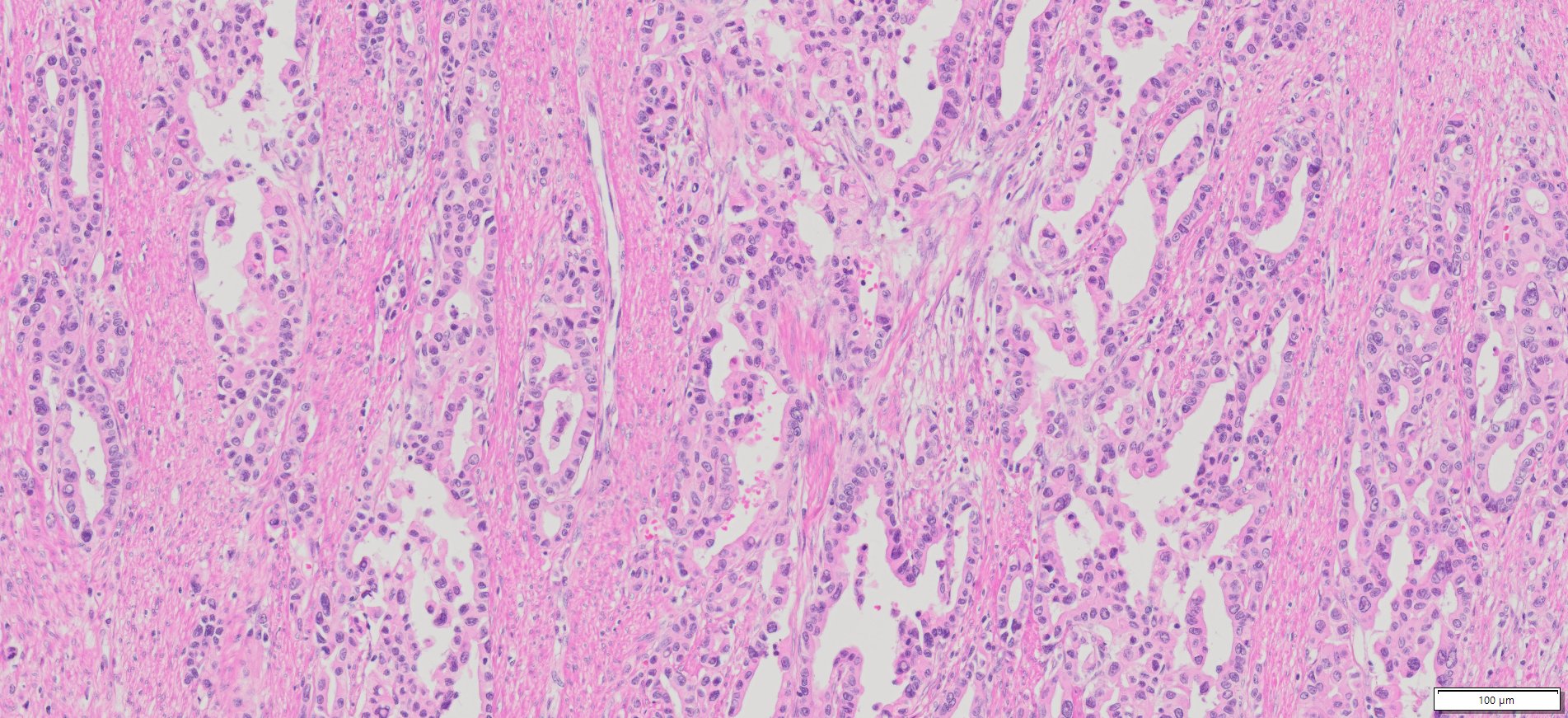 Human Gastric (Stomach adenocarcinoma) FFPE Sections