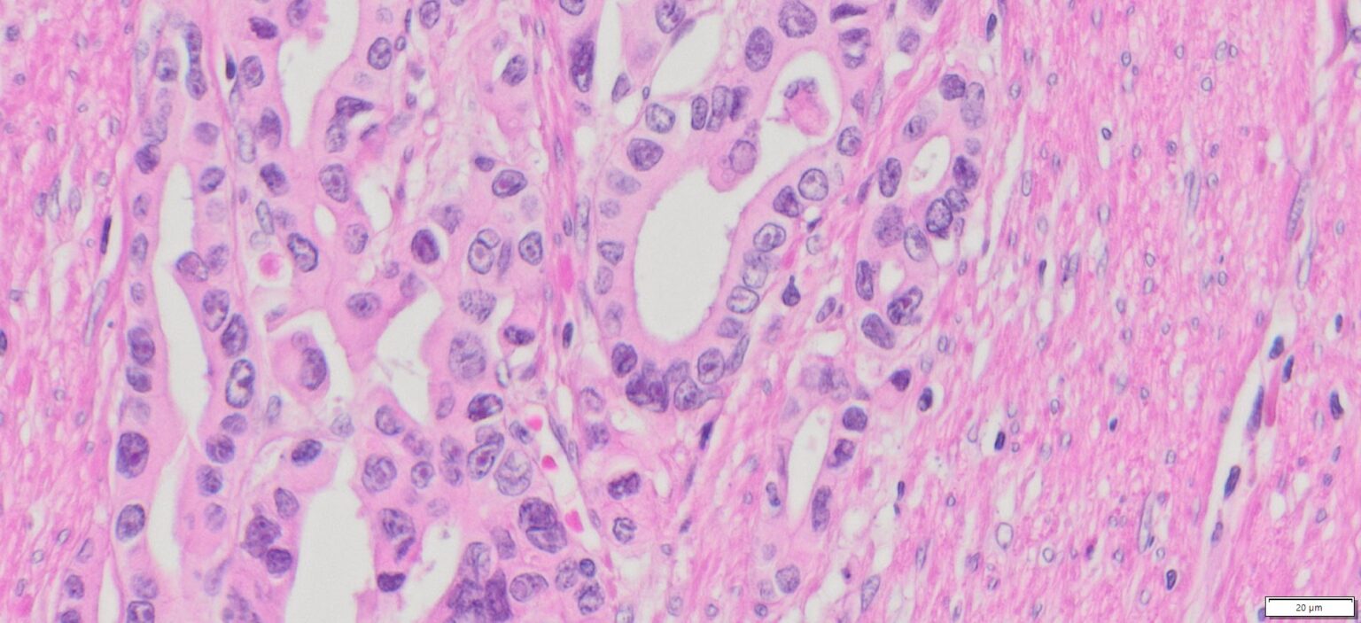 Human Gastric (Stomach adenocarcinoma) FFPE Sections