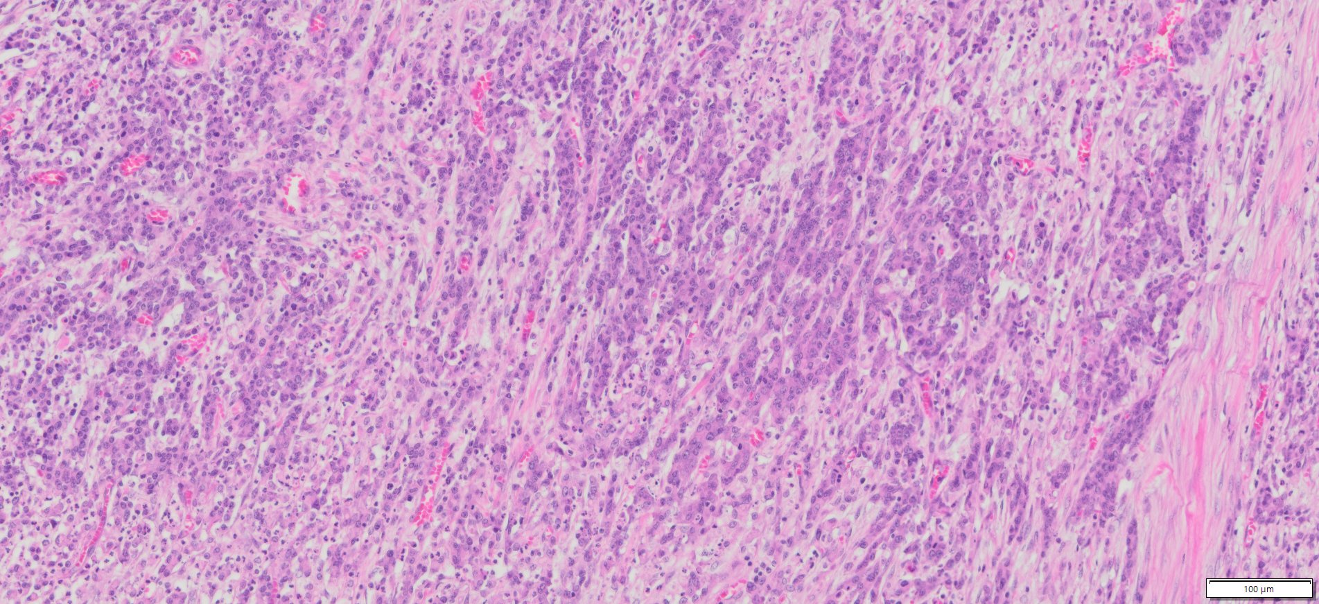Human Gastric (Stomach adenocarcinoma) FFPE Sections