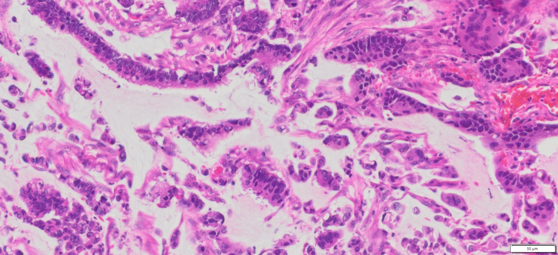 Human Gastric (Mucinous stomach adenocarcinoma) FFPE Sections