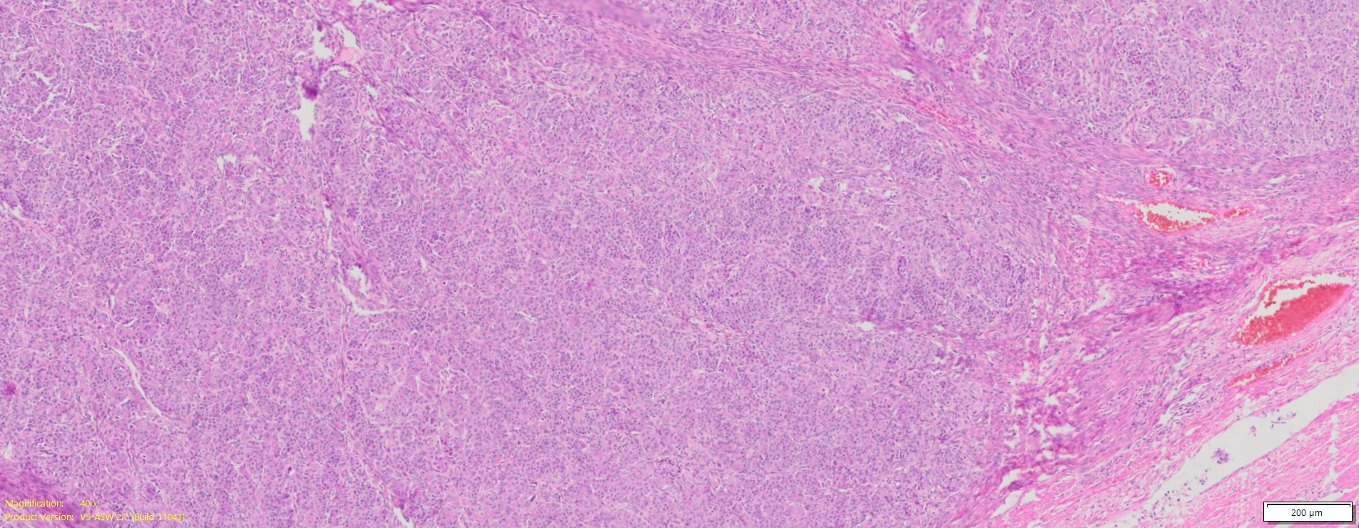 Human Ovary Cancer (Serous cyst adenocarcinoma) FFPE Sections