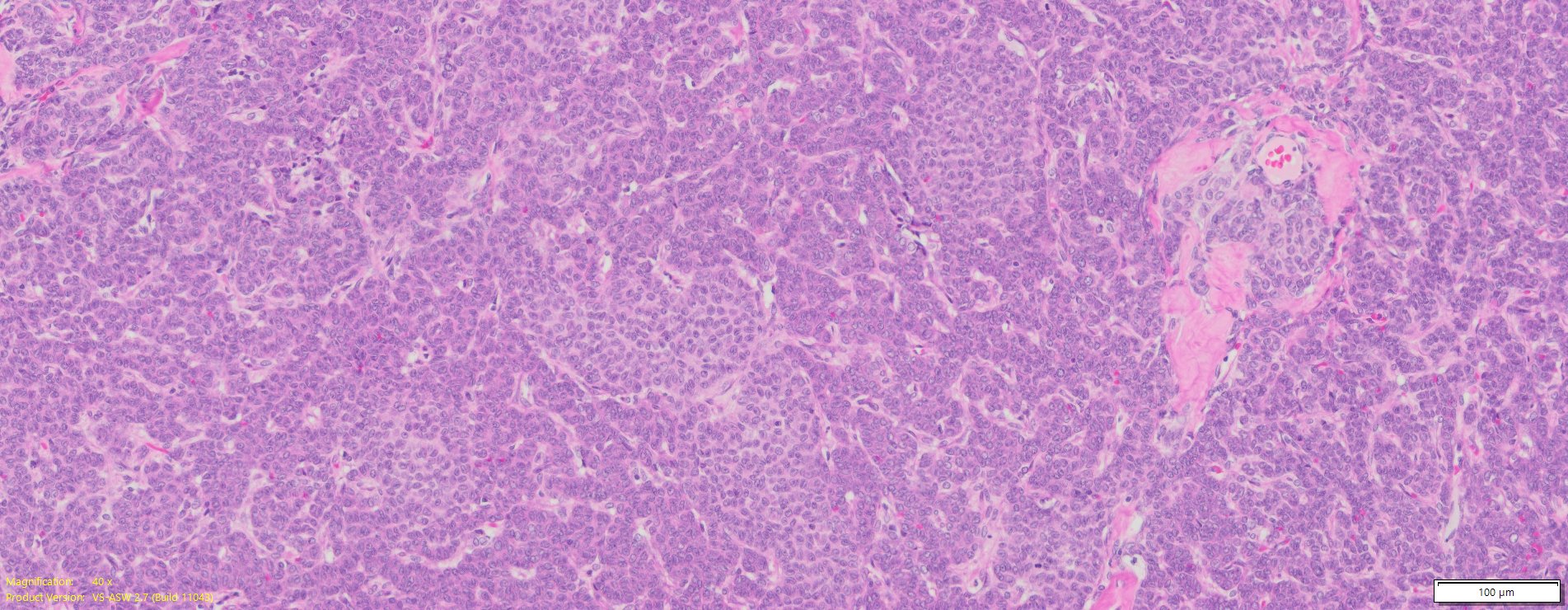 Human Ovary Cancer Granulosa Cell Tumor Ffpe Sections 8794