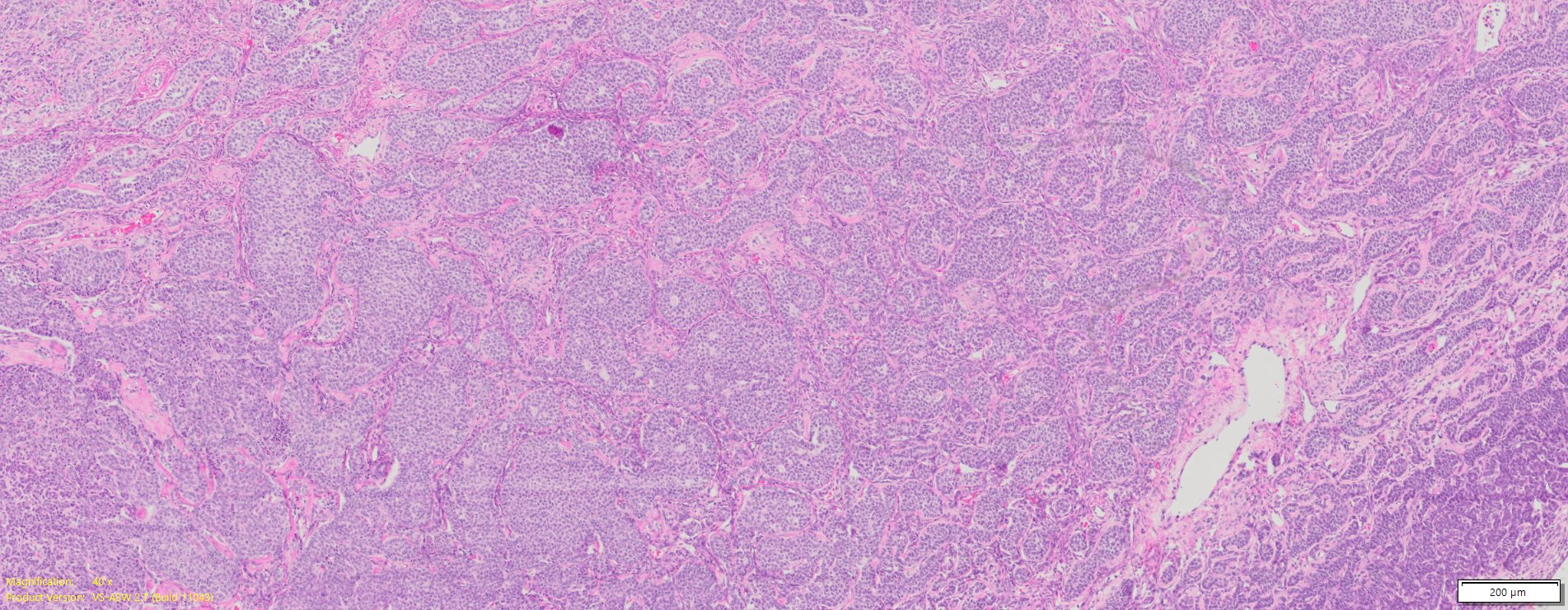 Human Ovary Cancer (Granulosa cell tumor) FFPE Sections